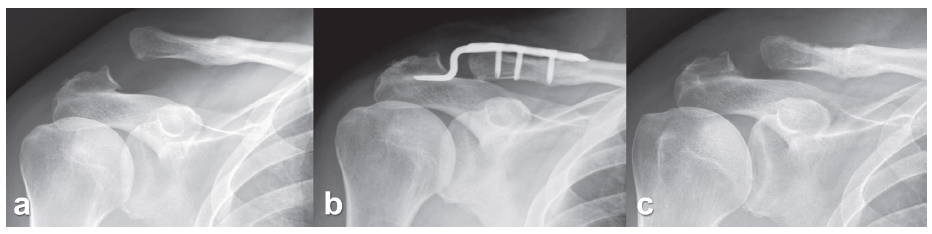 Chirurgická léčba akromioklavikulární luxace: Tahová cerkláž versus ...