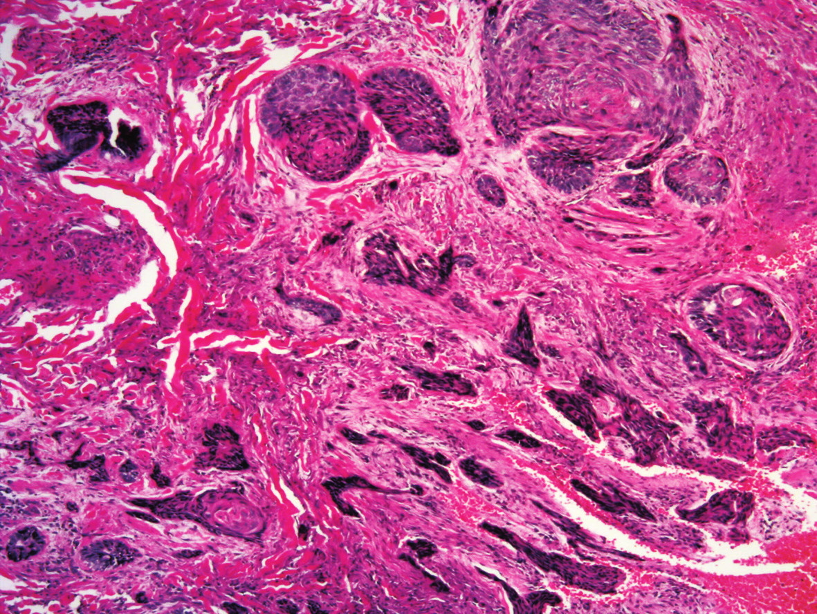 Basal cell carcinoma of the skin with mixed histomorphology: a ...