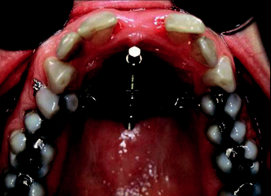 Distraction osteogenesis in the head and neck region | proLékaře.cz