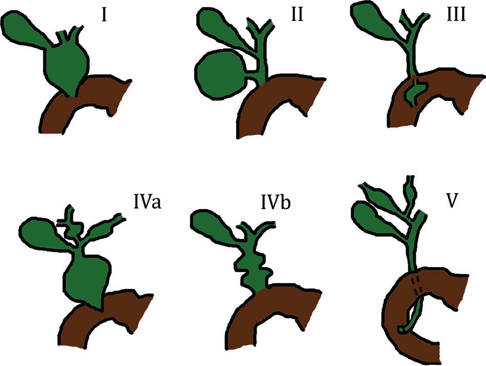 Cysta ductus choledochus | proLékaře.cz