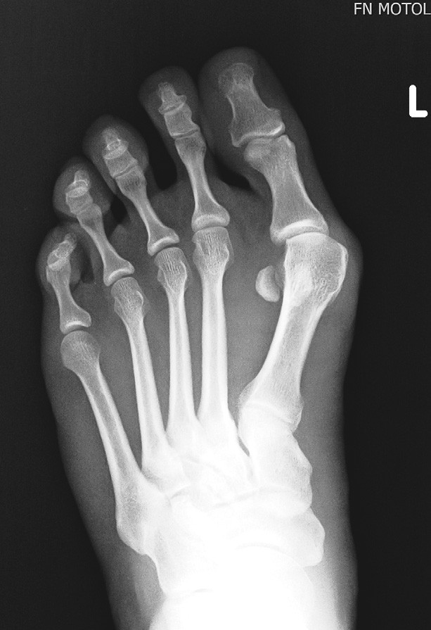Hallux valgus u pacientů s revmatoidní artritidou – současné možnosti ...