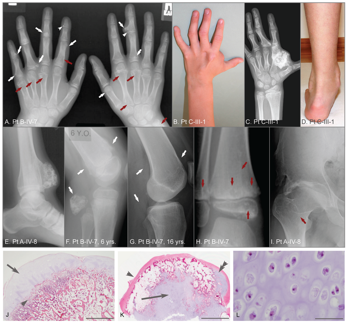 Loss-of-Function Mutations in Cause Metachondromatosis, but Not Ollier ...