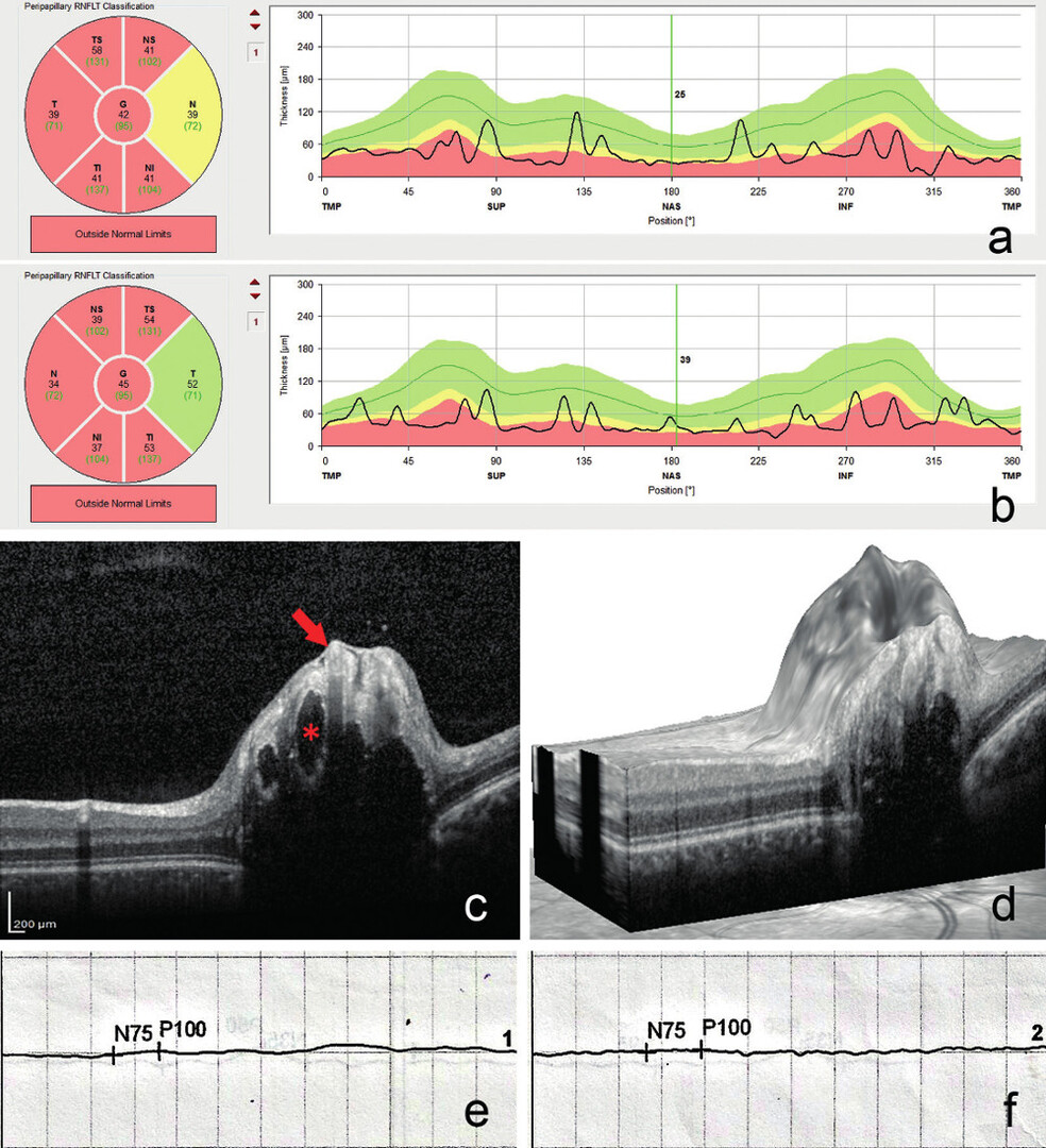 Příběh jedné papily | proLékaře.cz