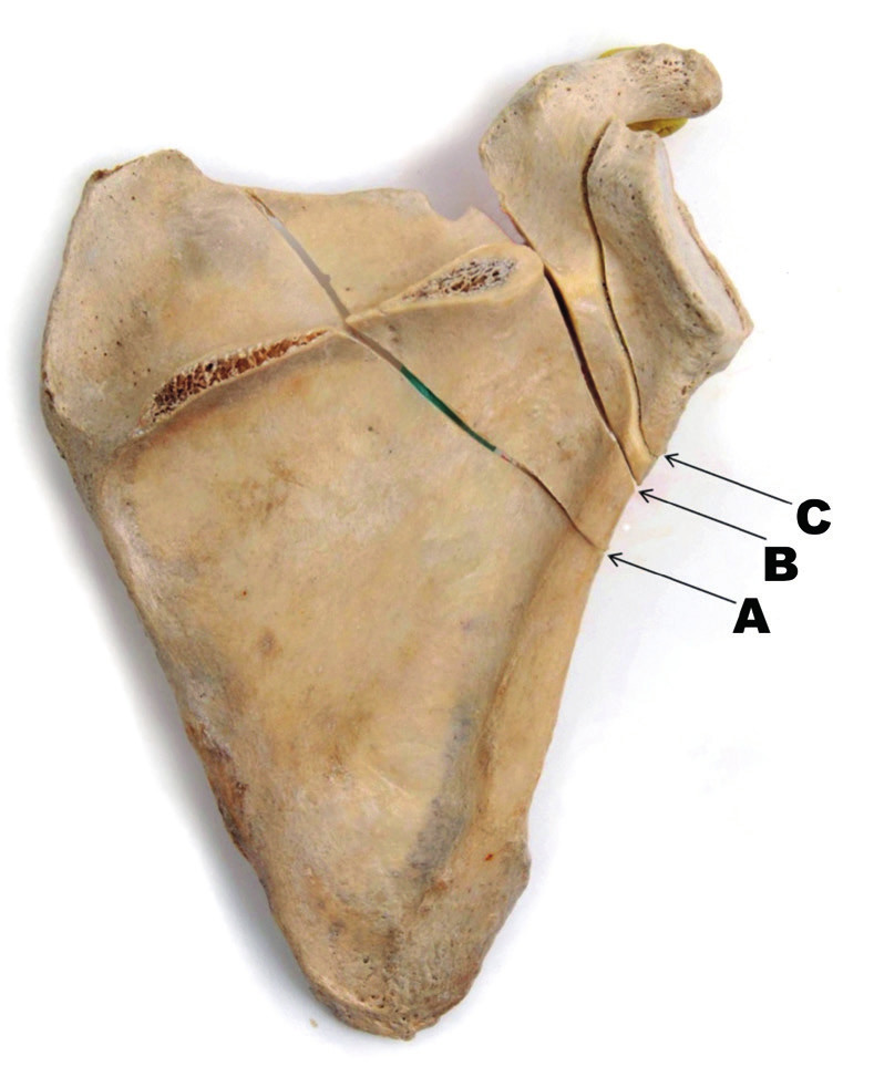 Zlomeniny lopatky | proLékaře.cz