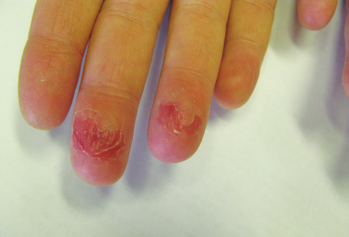 Retinoidy v dermatologii | proLékaře.cz