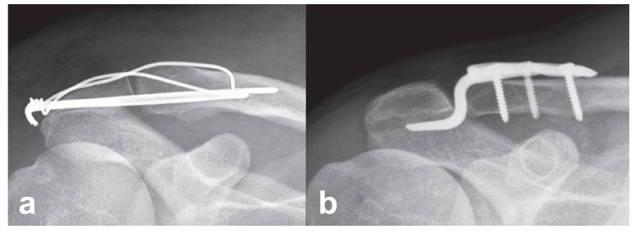 Chirurgická léčba akromioklavikulární luxace: Tahová cerkláž versus ...