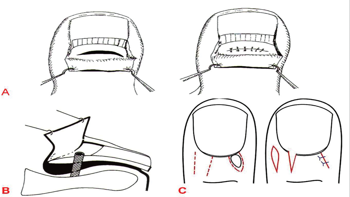 Chirurgie nehtového aparátu: úvod do problematiky, přehled operačních ...