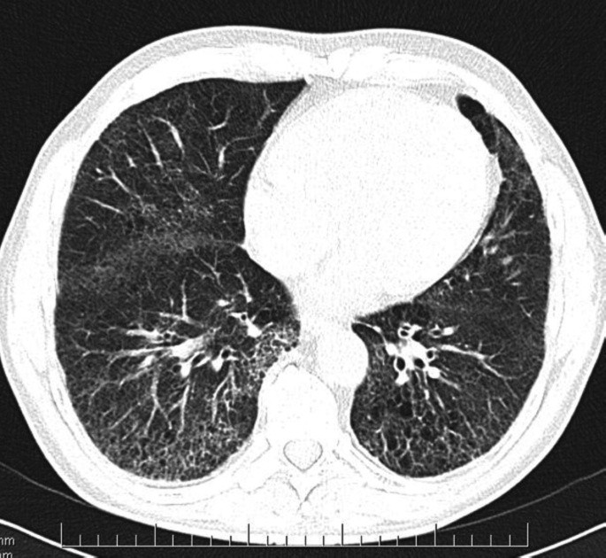 Syndrom kombinované fibrózy a emfyzému – CPFE syndrom | proLékaře.cz
