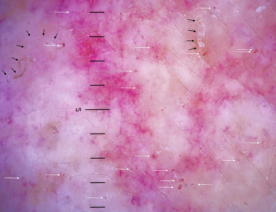 Hyperkeratotický exantém s pruritom | proLékaře.cz