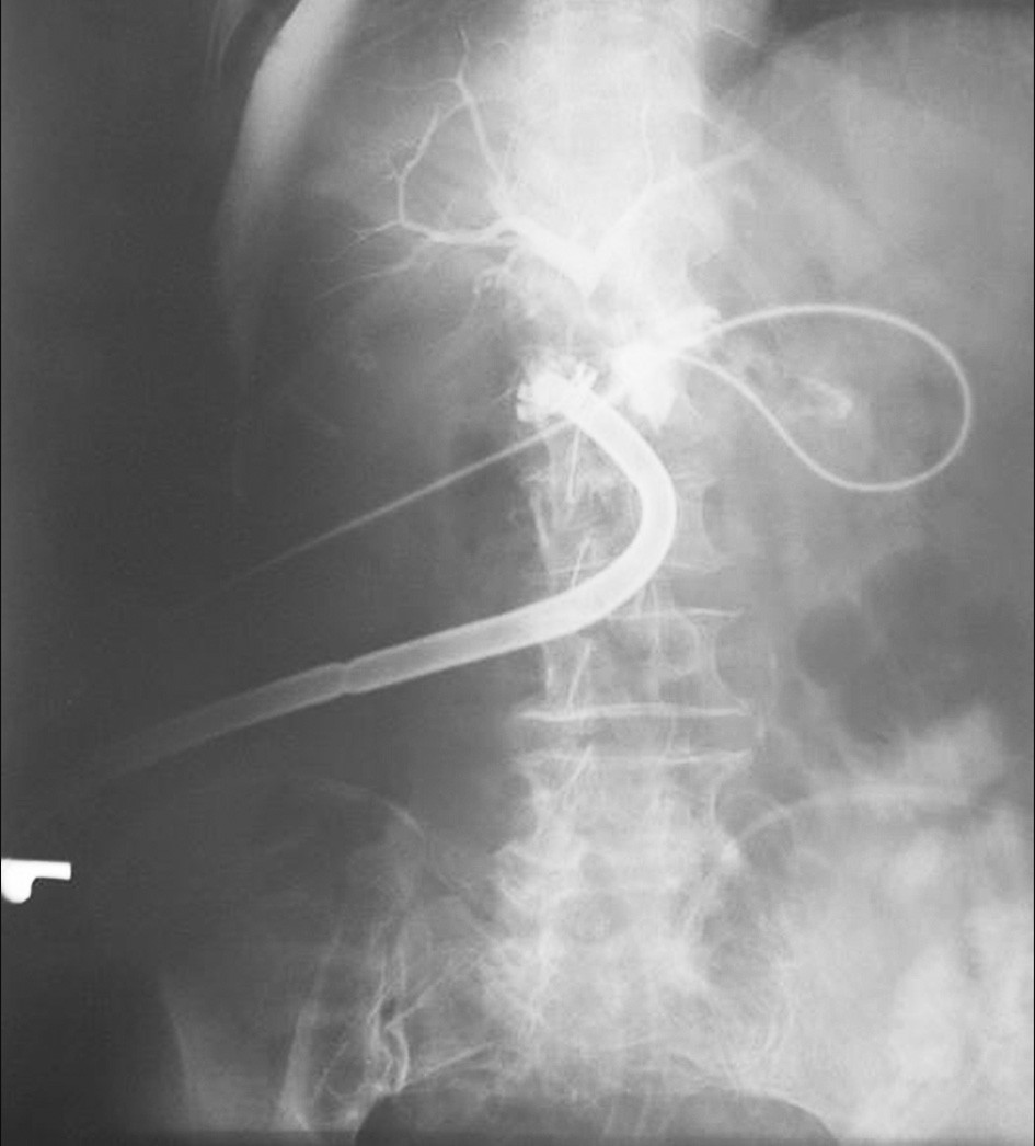Spontánna perforácia ductus choledochus pri akútnej pankreatitíde ...
