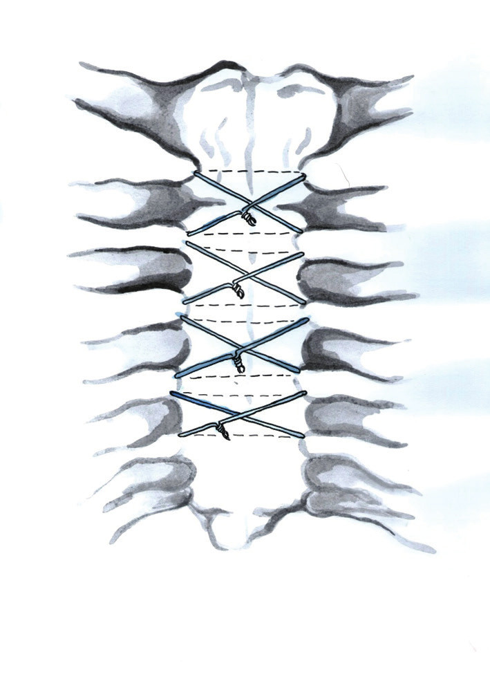 Přehled metod primárního uzávěru střední sternotomie | proLékaře.cz