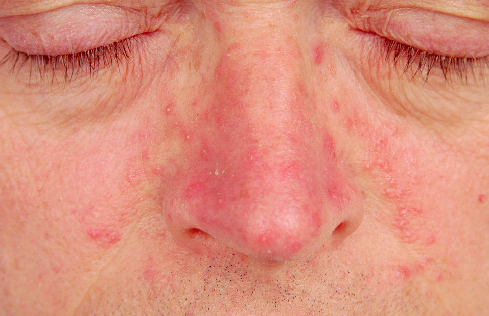Rosacea a dermatitis perioralis | proLékaře.cz