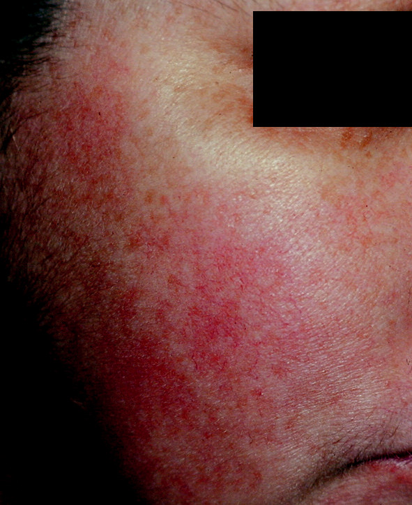 Rosacea a dermatitis perioralis | proLékaře.cz