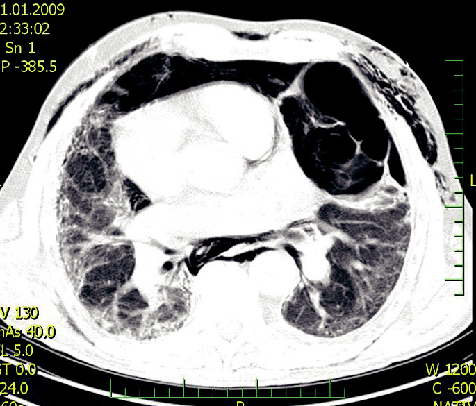 Syndrom kombinované fibrózy a emfyzému – CPFE syndrom | proLékaře.cz