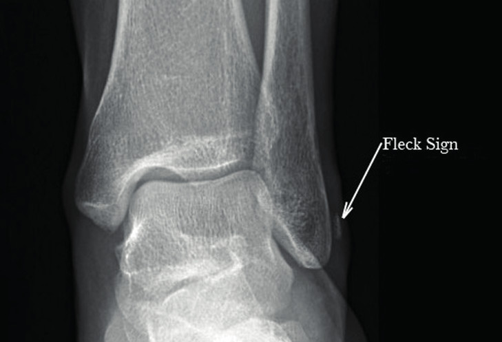 AKUTNÍ DISLOKACE PERONEÁLNÍCH ŠLACH – SOUBORNÝ REFERÁT | proLékaře.cz