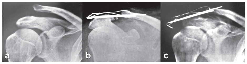 Chirurgická léčba akromioklavikulární luxace: Tahová cerkláž versus ...