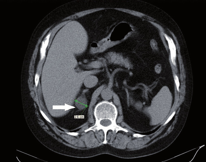 Je průkaz adenomu nadledviny u pacientů s primárním ...