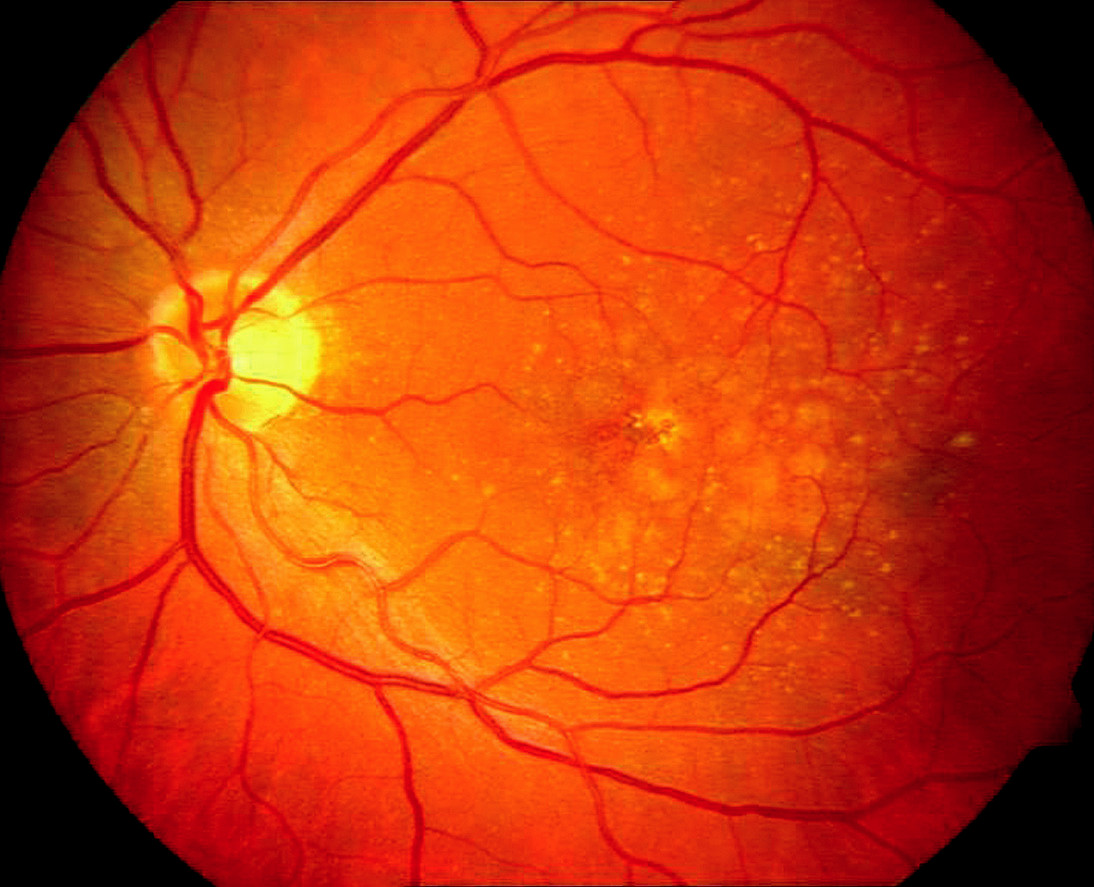 Ranibizumab (Lucentis) v léčbě věkem podmíněné makulární degenerace ...