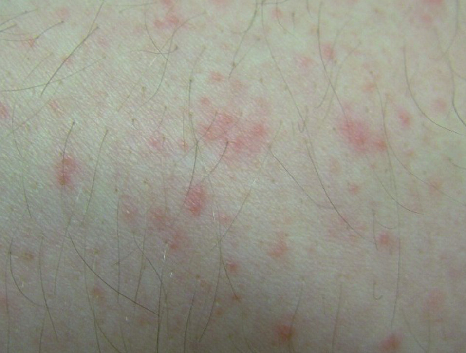 Miliaria pustulosa | proLékaře.cz