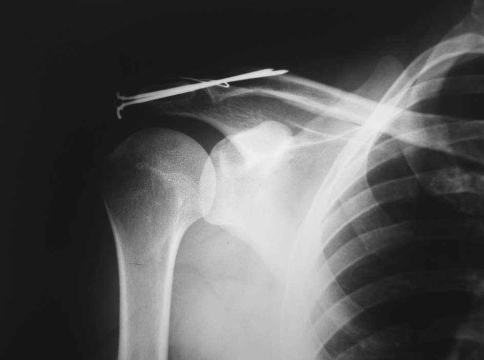 Klinické výsledky operačního řešení acromioclaviculární luxace se ...