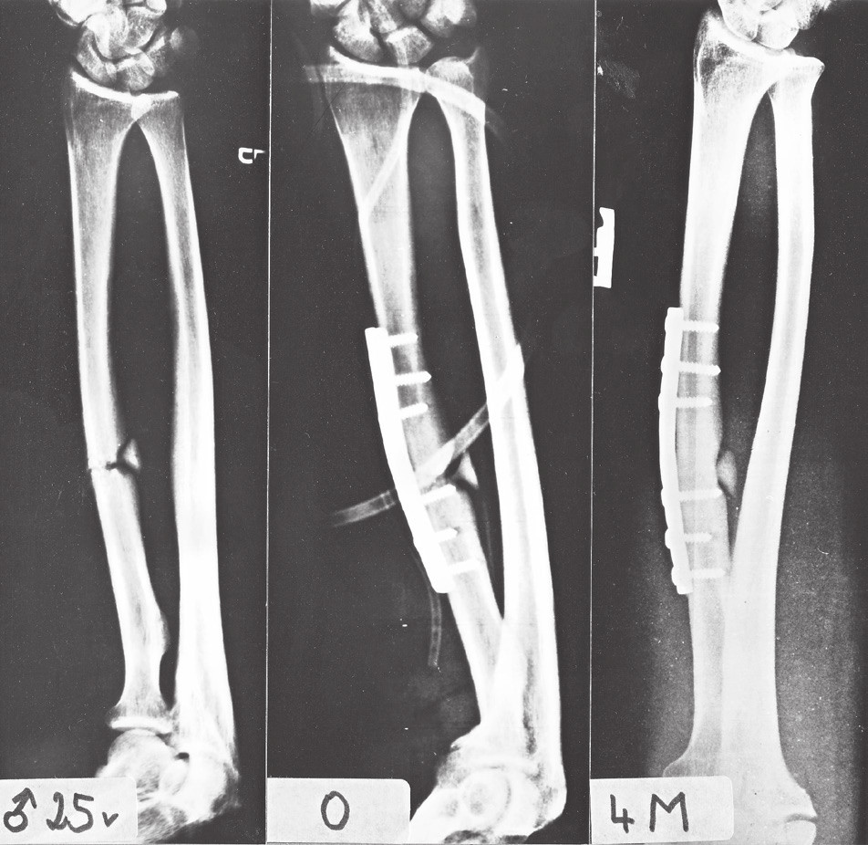 Osteosyntéza zlomenin diafýzy radia: Anatomické a biomechanické ...