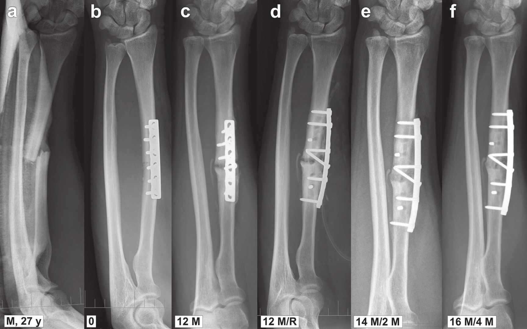 Osteosyntéza zlomenin diafýzy radia: Anatomické a biomechanické ...