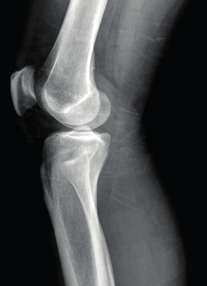 Luxace proximálního tibiofibulárního kloubu - kazuistika | proLékaře.cz