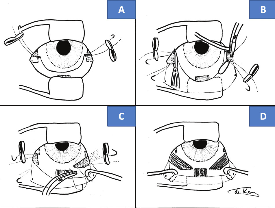 Vertical Strabismus – Indication of Surgical Techniques on the Inferior ...