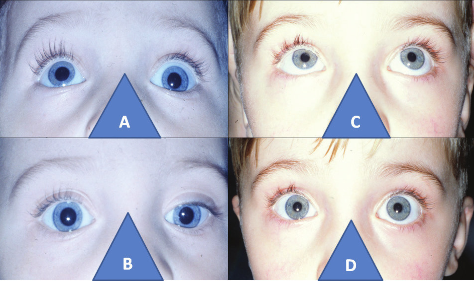 Vertical Strabismus – Indication of Surgical Techniques on the Inferior ...