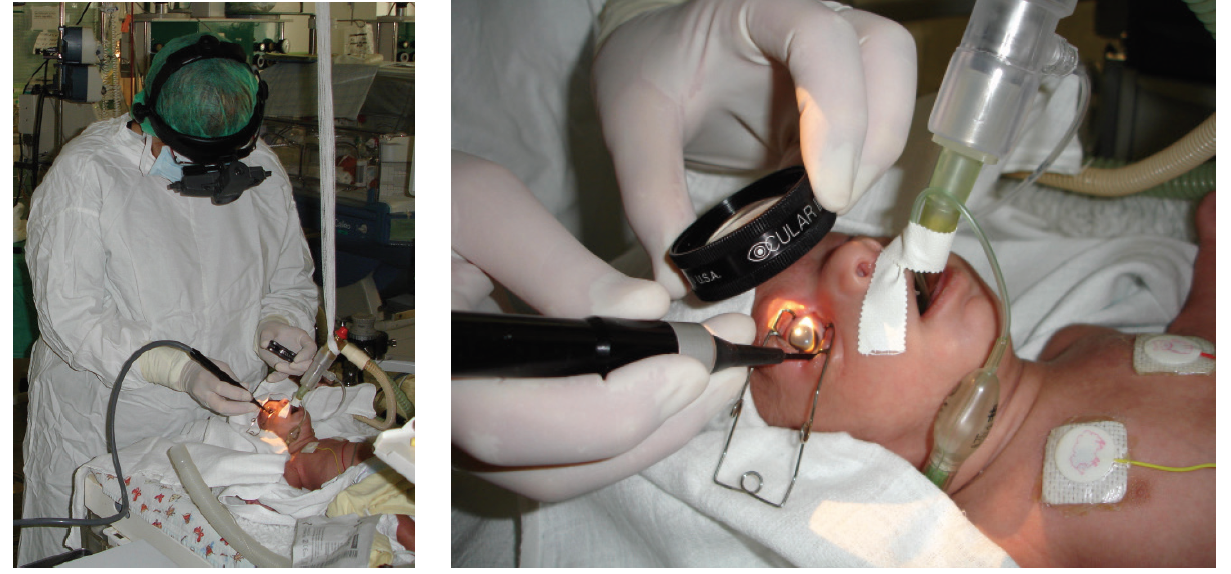 Screening, Treatment and Long-term Observation of Retinopathy of ...