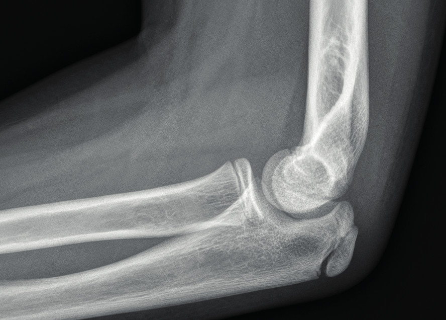 Ossification Centers Elbow